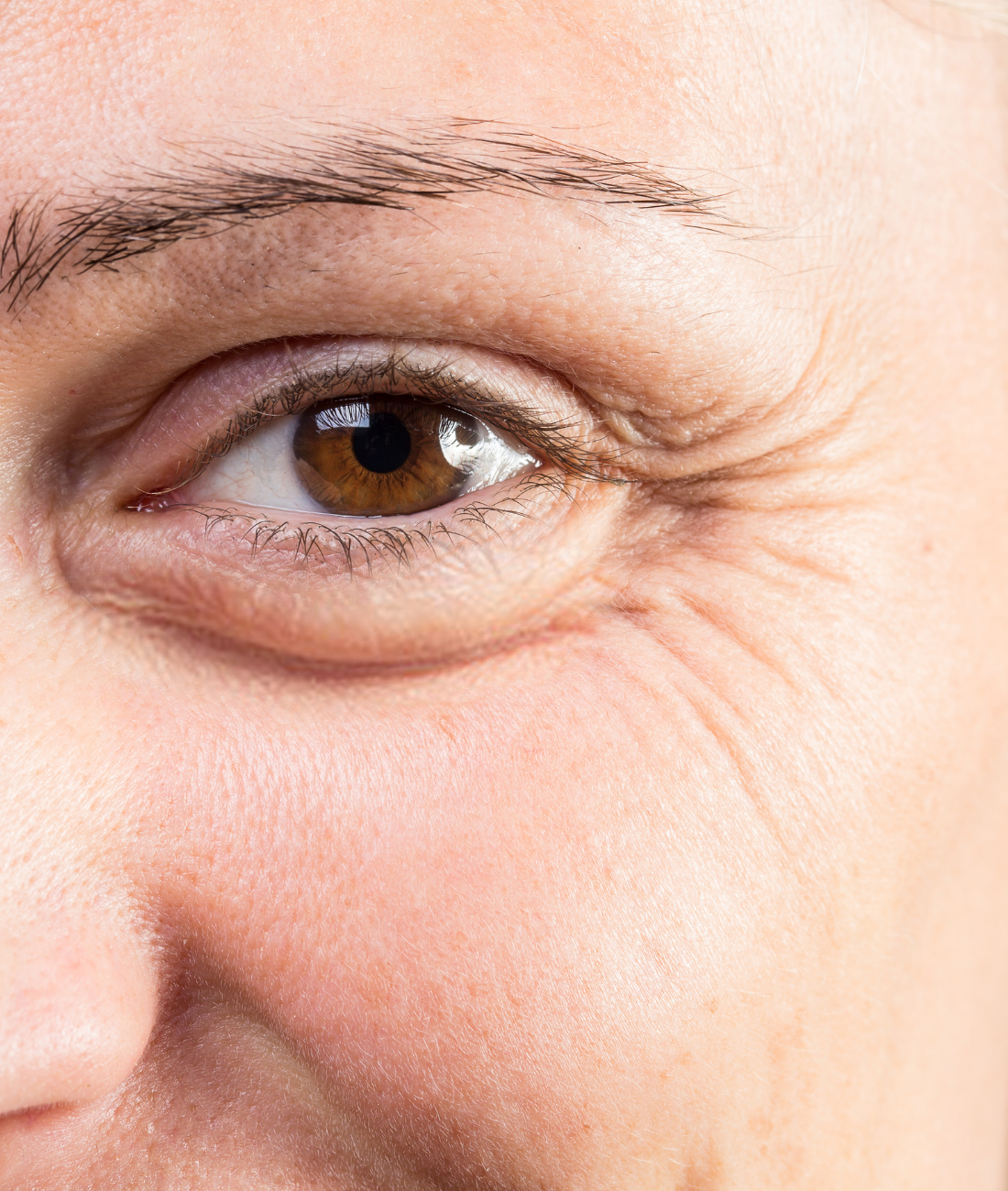 Crow's Feet - Causes & Treatments in Cannock | Youtopia Medical